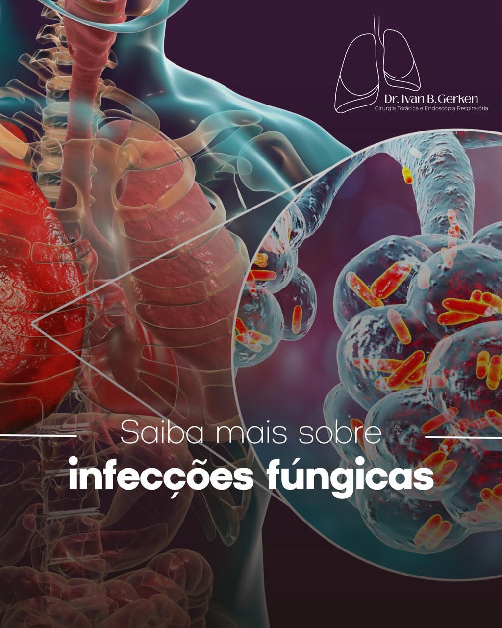 Saiba sobre as infecções fúngicas - Dr. Ivan Gerken | Cirurgião ...