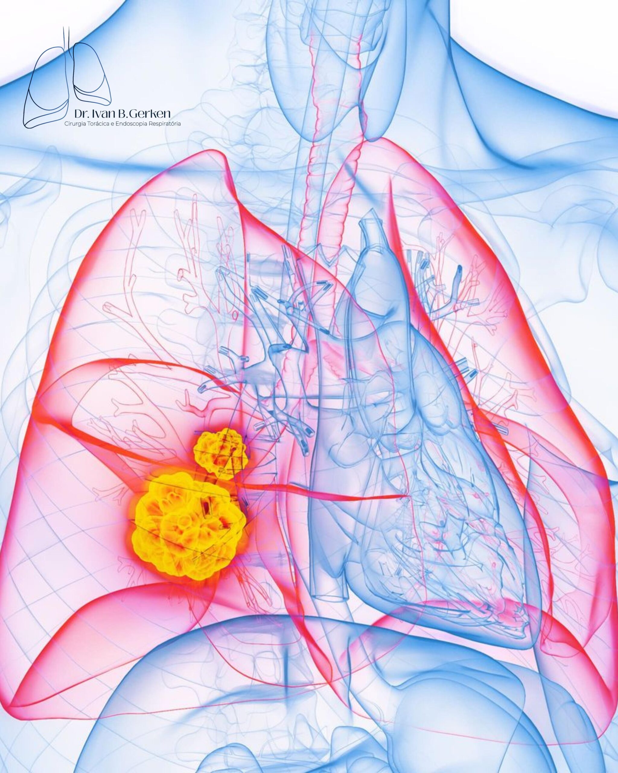 Nódulos Pulmonares: O que Você Precisa Saber - Dr. Ivan Gerken ...
